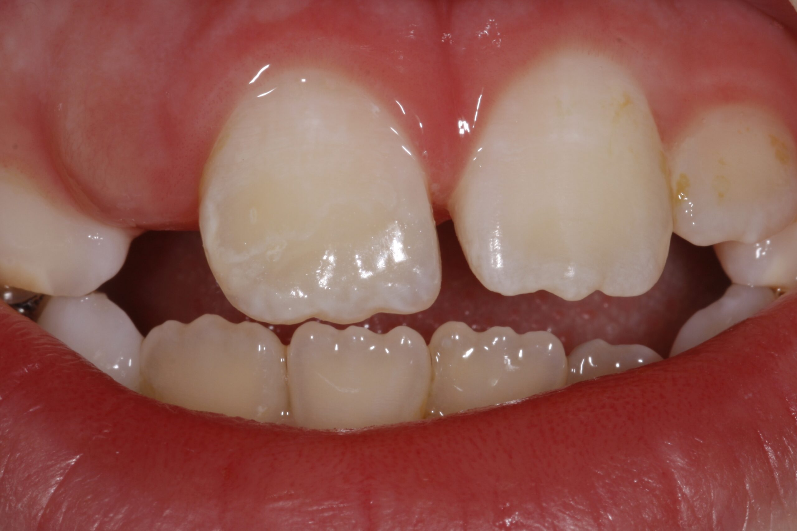 ماملون دندان چیست و چه درمانی دارد؟ - دنتچی